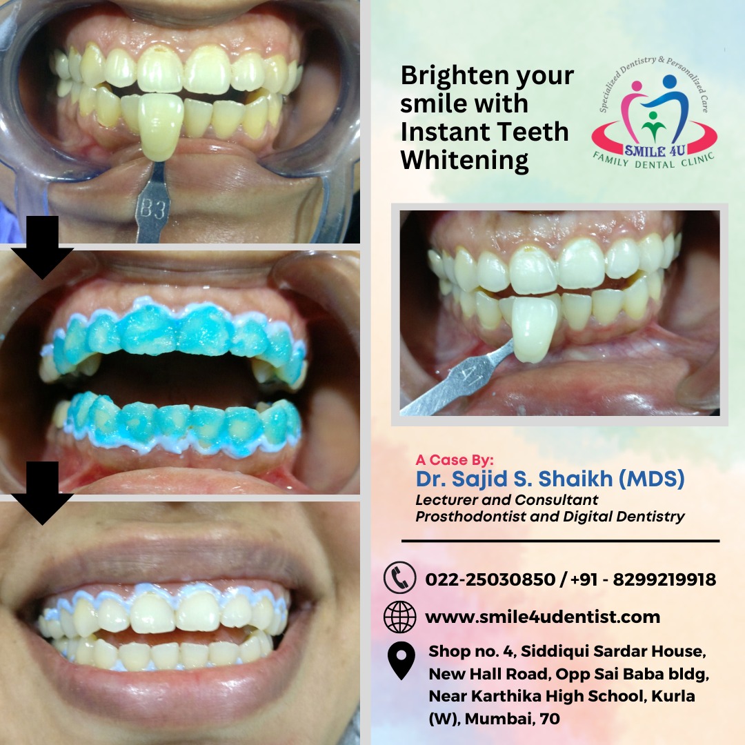 teeth whitening service in Kurla, teeth whitening service in Mumbai