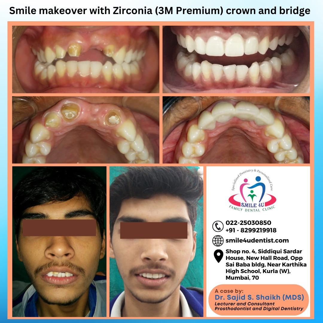 braces treatment in Mumbai. dental implants in Mumbai, Kurla